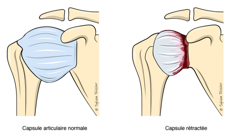 Capsulite et algodystrophie - Centre Epaule Angers
